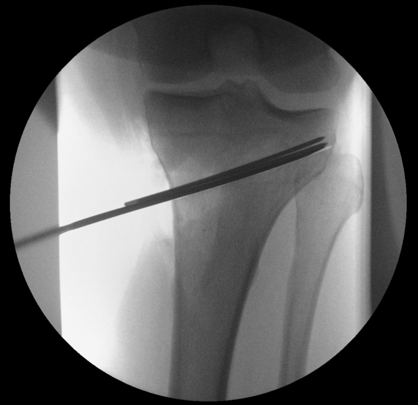 Keyhole Knee Surgery | Knee Injury Treatment Tunbridge Wells